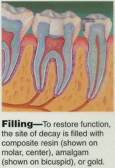 Fillings, decay and cavities -- Naperville Dentist J.A. Haselhorst